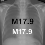A Comprehensive Guide to ICD-10 Code M54.4 - wmwtl