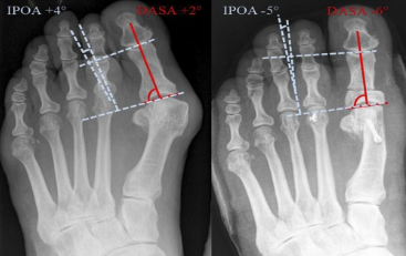 The Essential Guide to CPT Code for an Akin Osteotomy - wmwtl