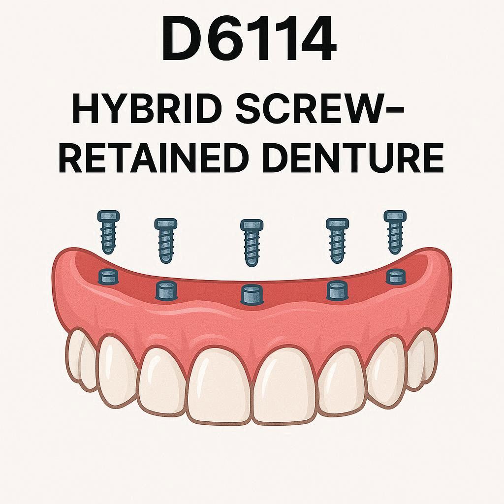 The Ultimate Guide to the Dental Code for Hybrid Screw-Retained Denture ...